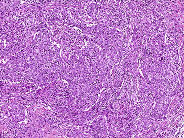 Invasive Carcinoma