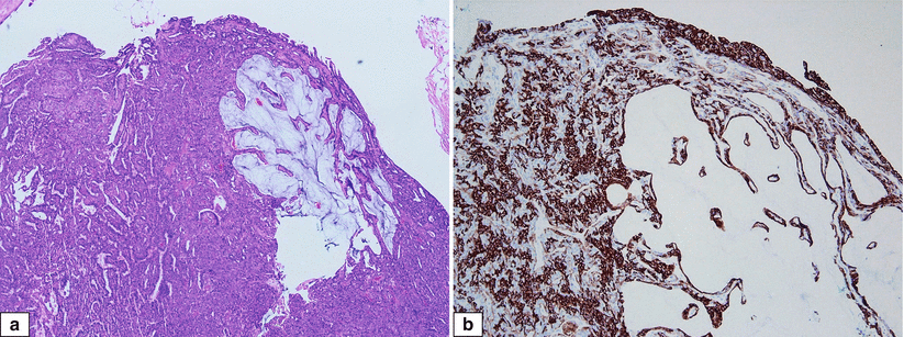 Mucinous Lesions | Basicmedical Key