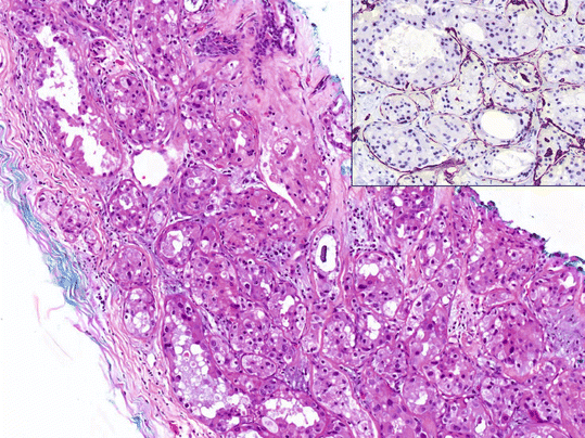 Apocrine Lesions | Basicmedical Key