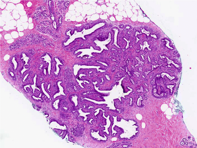 Intraductal Proliferative Lesions | Basicmedical Key