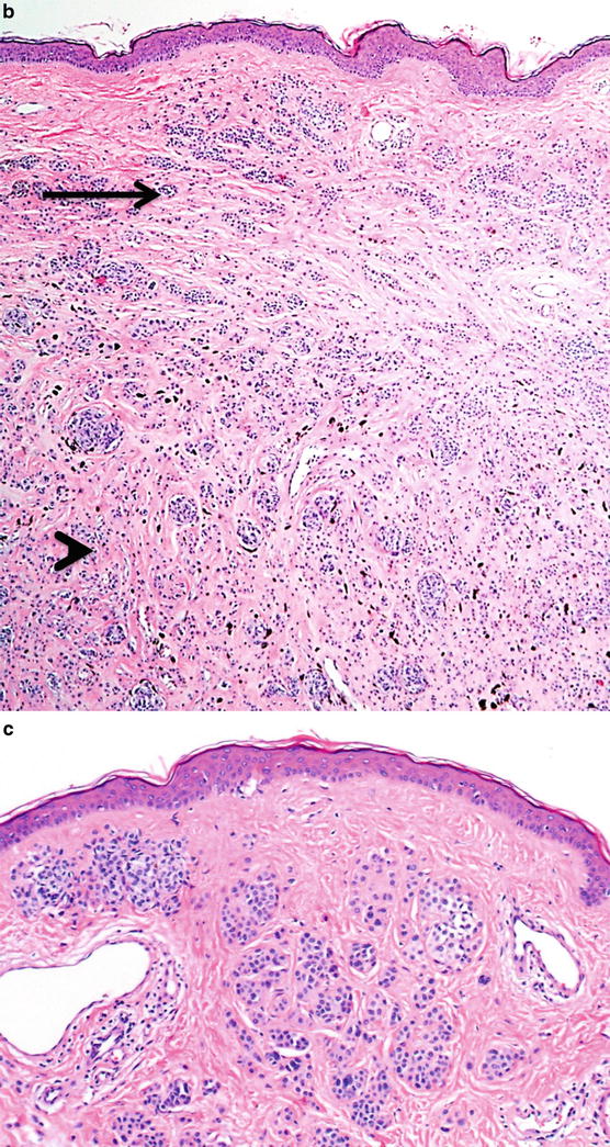 Acquired Melanocytic Nevus | Basicmedical Key