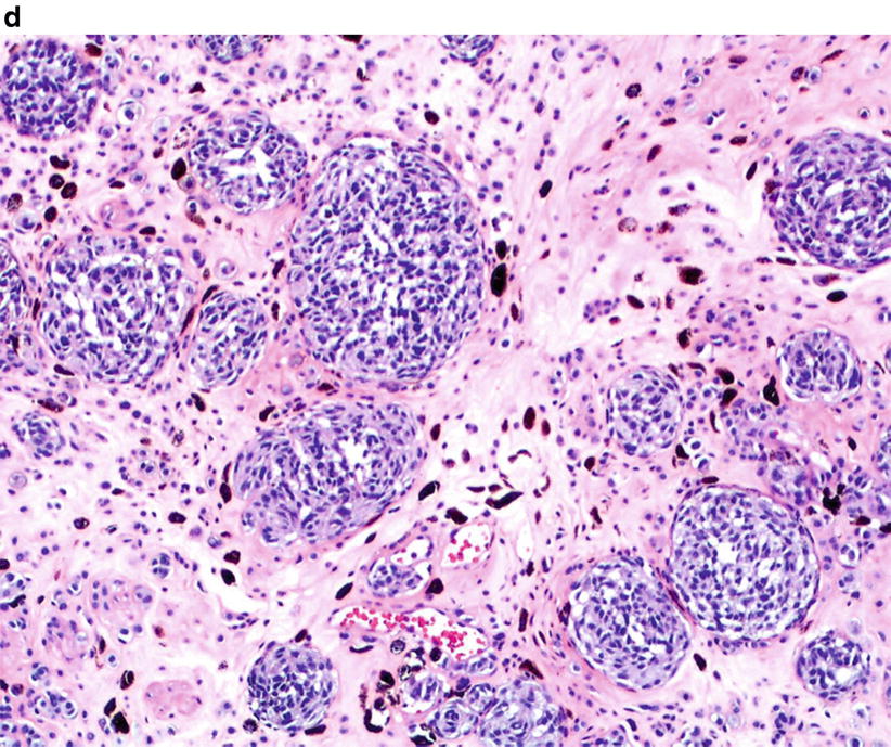 Acquired Melanocytic Nevus | Basicmedical Key