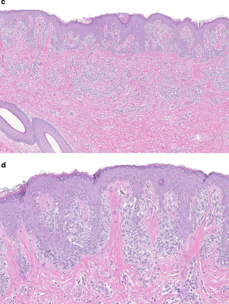 Acquired Melanocytic Nevus | Basicmedical Key