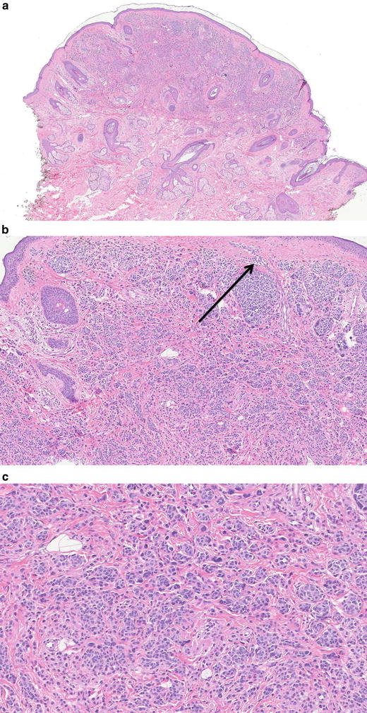 Acquired Melanocytic Nevus | Basicmedical Key