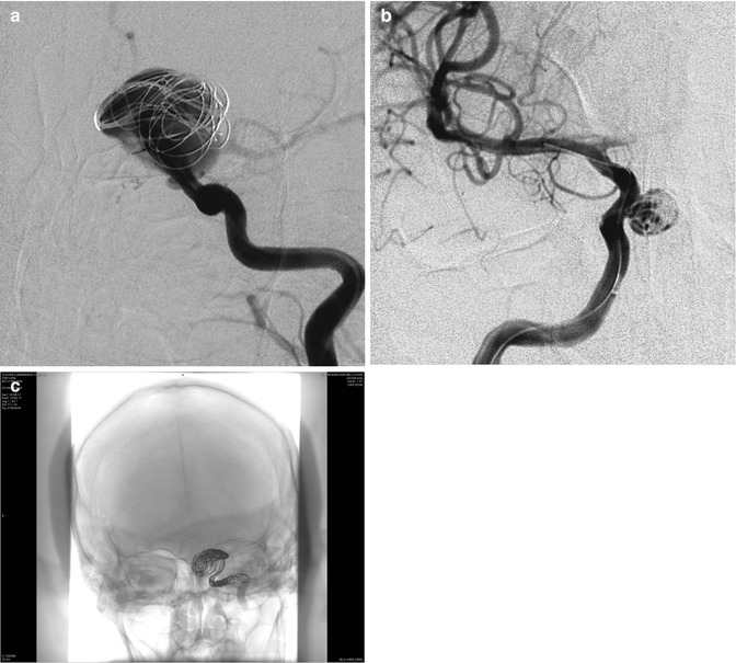 Carotid Artery Aneurysm | Basicmedical Key