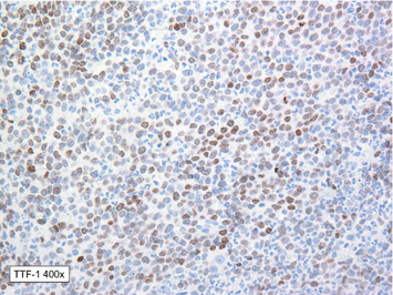 NUT Carcinoma | Basicmedical Key