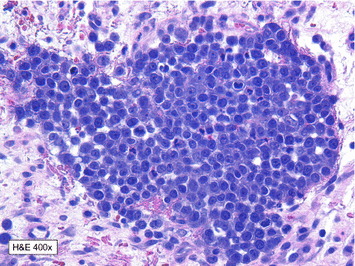 NUT Carcinoma | Basicmedical Key