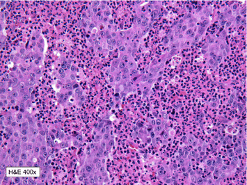 NUT Carcinoma | Basicmedical Key