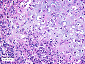 NUT Carcinoma | Basicmedical Key
