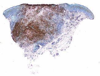 Histological Clues in Interpreting Vulvar Inflammatory and Autoimmune ...