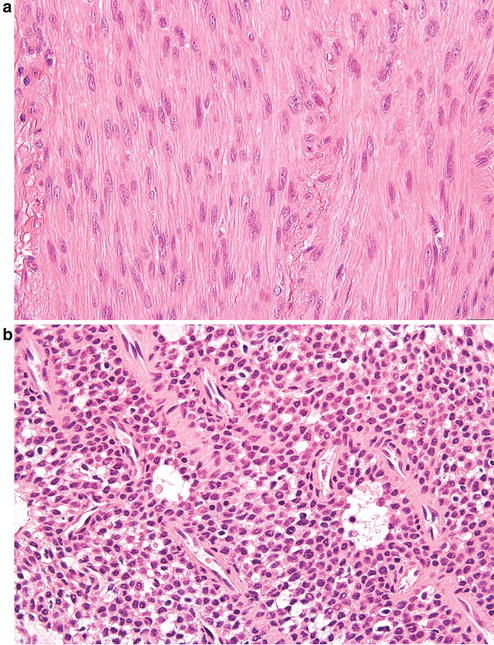Smooth Muscle and Perivascular Tumors | Basicmedical Key