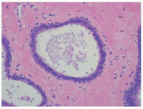 Nonproliferative Alterations of Acini | Basicmedical Key