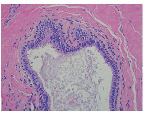 Nonproliferative Alterations of Acini | Basicmedical Key