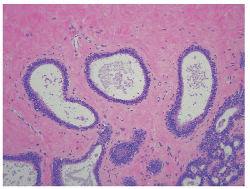 Nonproliferative Alterations of Acini | Basicmedical Key