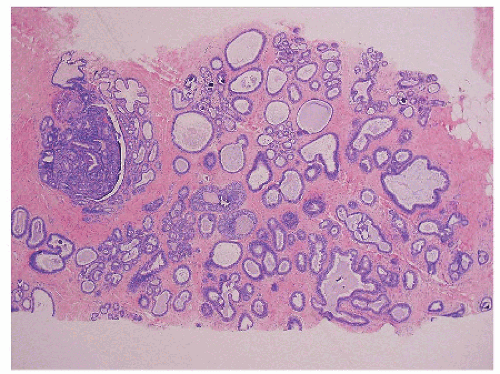 Epithelial Proliferative Lesions, Usual and Atypical Ductal Hyperplasia ...