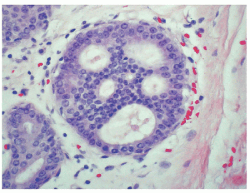 Epithelial Proliferative Lesions, Usual and Atypical Ductal Hyperplasia ...