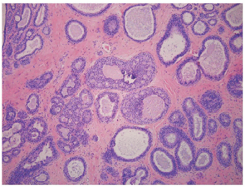 Epithelial Proliferative Lesions, Usual and Atypical Ductal Hyperplasia ...