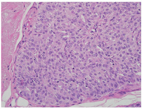 Lobular Neoplasia and Its Distinction from Other Epithelial ...