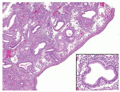 Uterine Corpus (Epithelial Lesions) | Basicmedical Key