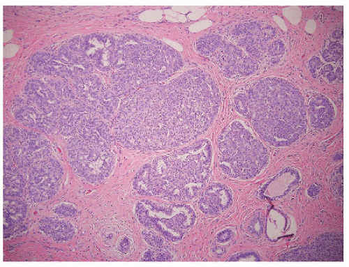 Papillary and Sclerosing Lesions | Basicmedical Key