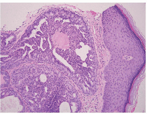 Papillary and Sclerosing Lesions | Basicmedical Key