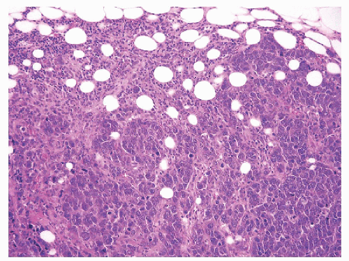 Invasive Carcinoma: Special Types and Important Considerations ...