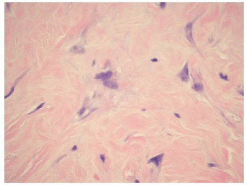 Benign and Reactive Stromal Lesions | Basicmedical Key