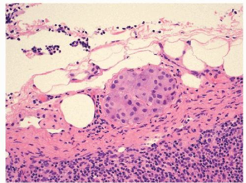 Sentinel Lymph Nodes | Basicmedical Key
