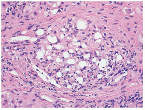 Granulomatous Liver Disease | Basicmedical Key