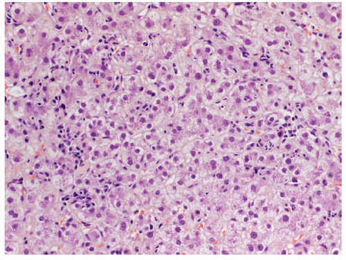 Autoimmune Hepatitis | Basicmedical Key