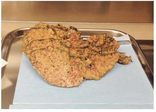 Gross Processing of Liver Specimens | Basicmedical Key