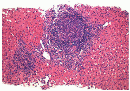 Basic Patterns of Injury in Medical Liver Pathology | Basicmedical Key