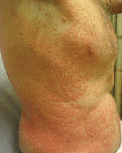 Sézary Syndrome | Basicmedical Key