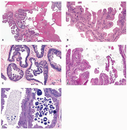 Apocrine Carcinoma | Basicmedical Key