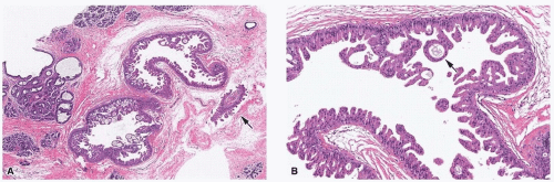 Apocrine Carcinoma | Basicmedical Key