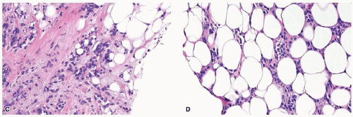 Invasive Lobular Carcinoma | Basicmedical Key