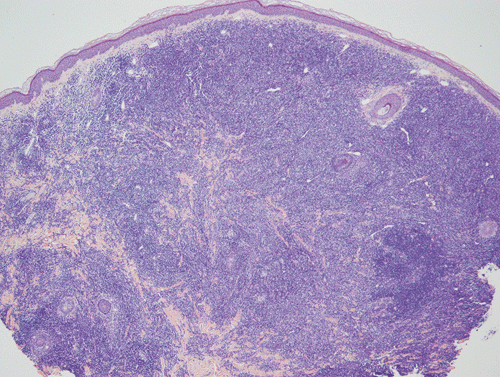 Primary Cutaneous Marginal Zone B-Cell Lymphoma | Basicmedical Key