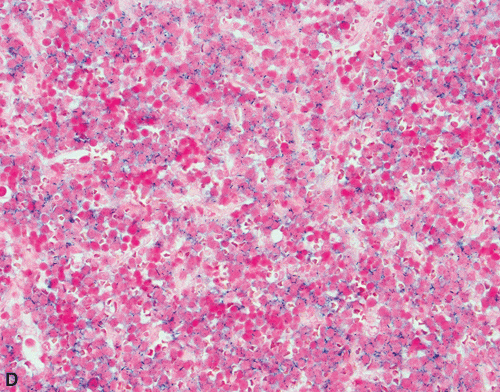 Cutaneous Plasma Cell Neoplasms | Basicmedical Key