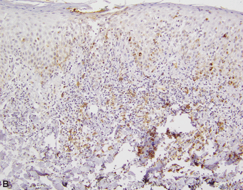 Cutaneous Mantle Cell Lymphoma | Basicmedical Key