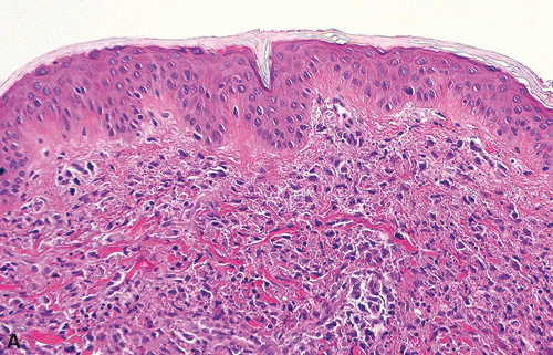 Leukemia Cutis/Aleukemic Leukemia Cutis/Myeloid Sarcoma | Basicmedical Key