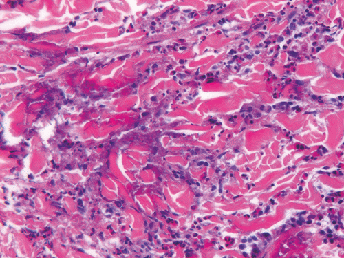 Wells Syndrome (Eosinophilic Cellulitis) | Basicmedical Key