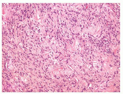 Soft Tissue Tumors | Basicmedical Key