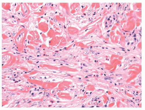 Soft Tissue Tumors | Basicmedical Key
