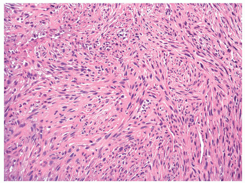 Soft Tissue Tumors | Basicmedical Key