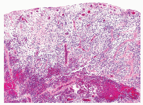 Pathology of the Ear | Basicmedical Key