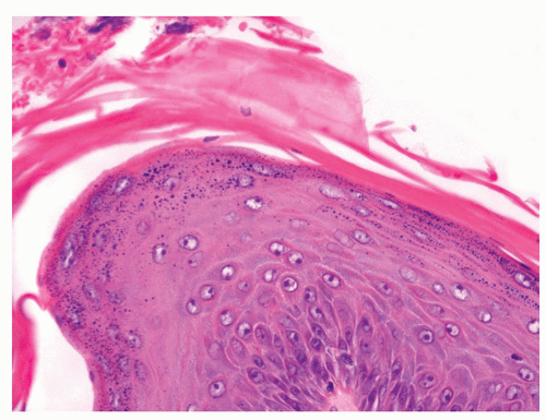 Benign Squamous Proliferations and Neoplasms | Basicmedical Key