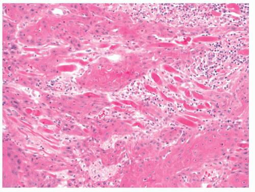 Conventional Squamous Cell Carcinoma | Basicmedical Key