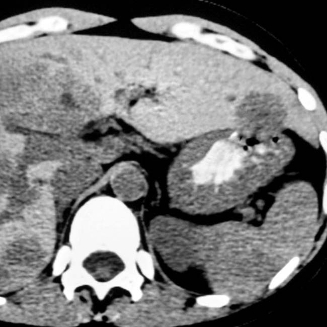 Zollinger-Ellison Syndrome | Clinical Gate