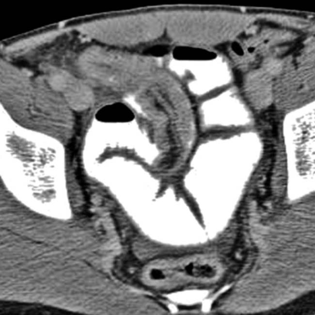 Intussusception | Clinical Gate