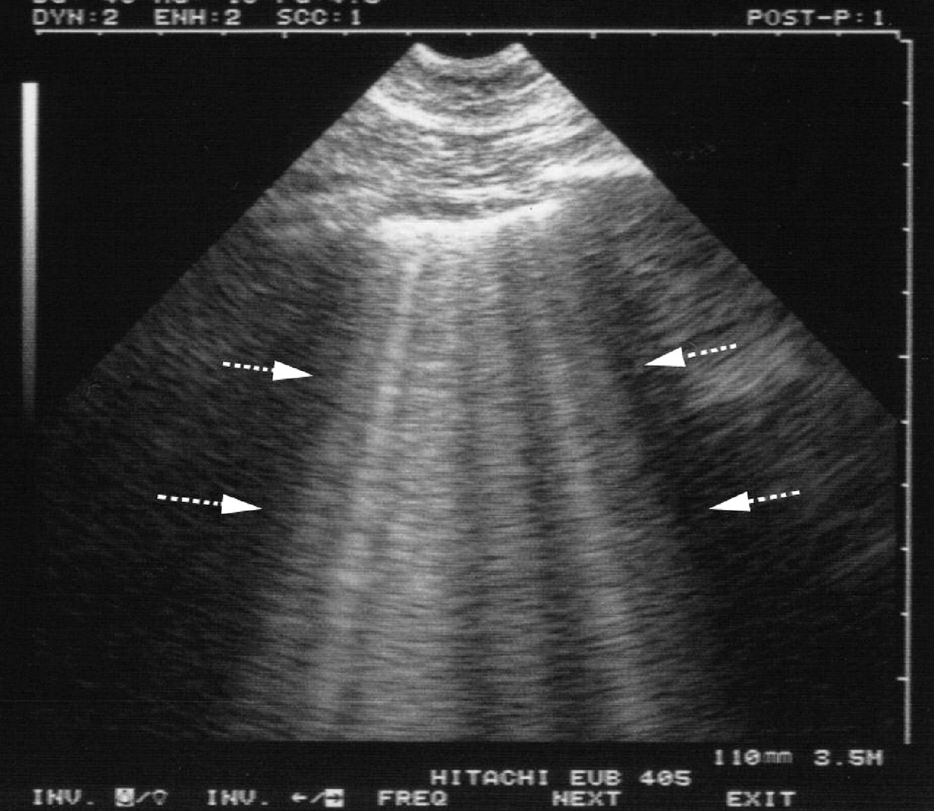 acute-pulmonary-edema-core-em